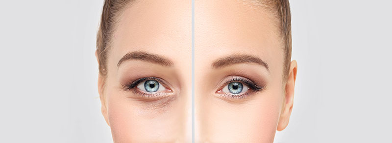 Sagging Eyelids: How Lasers Can Help - Dr. Goodnight's Everlasting Beauty